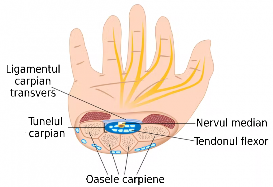 Ce este sindromul de tunel carpian? – Neurochirurgia pentru toți
