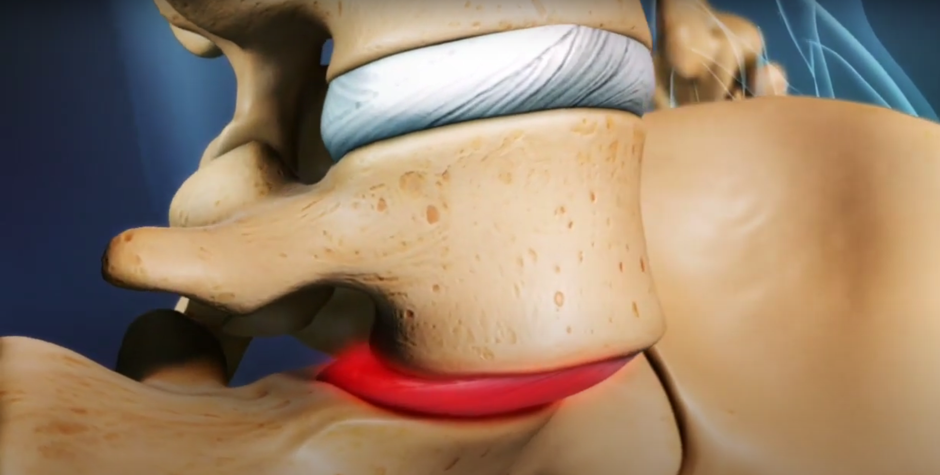 Ce este spondilolisteza? – Neurochirurgia pentru toți