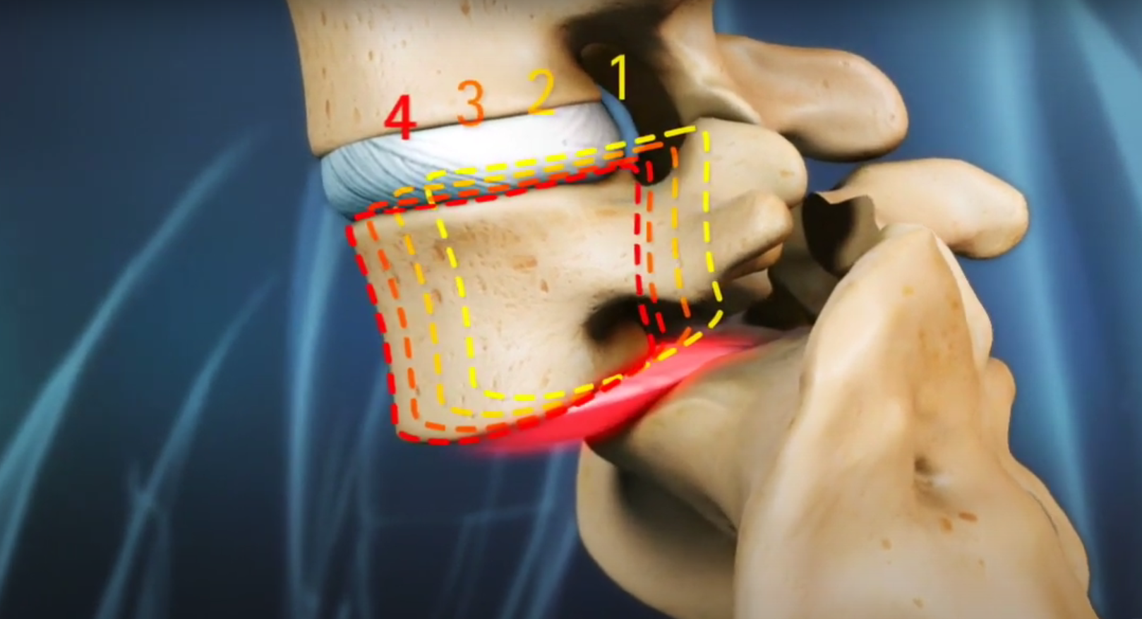 Ce este spondilolisteza? – Neurochirurgia pentru toți